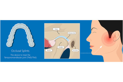 What You Need To Know About TMJ Appliances - Head Pain Institute
