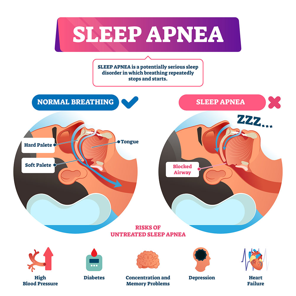 Top Three Myths About Sleep Apnea Debunked Head Pain Institute
